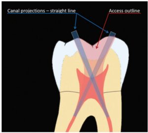 Preserving tooth structure — key when accessing canals