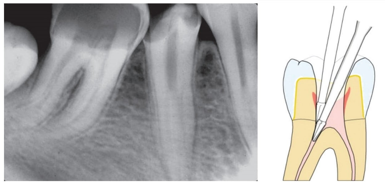 Preserving tooth structure — key when accessing canals