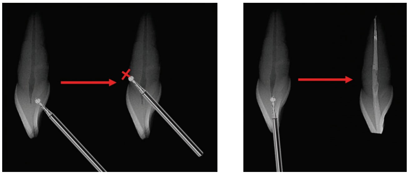 Preserving tooth structure — key when accessing canals