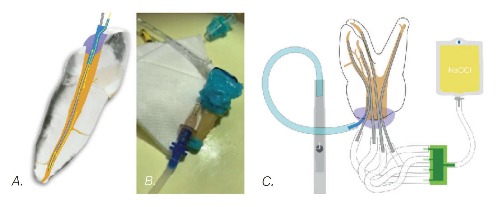 Irrigation of root canals — overcome the challenges