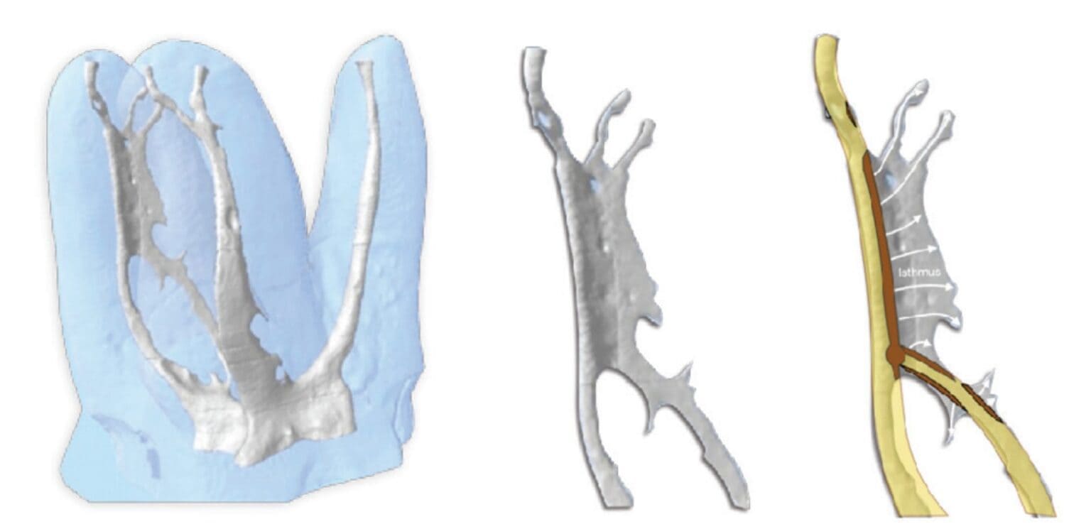 Irrigation of root canals — overcome the challenges