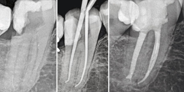 Case Studies - Endodontic Practice US - Dental Journal and Online Dental CE