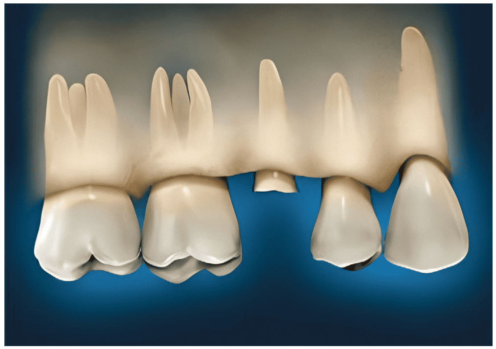 Endodontics or implants — what’s the best choice?