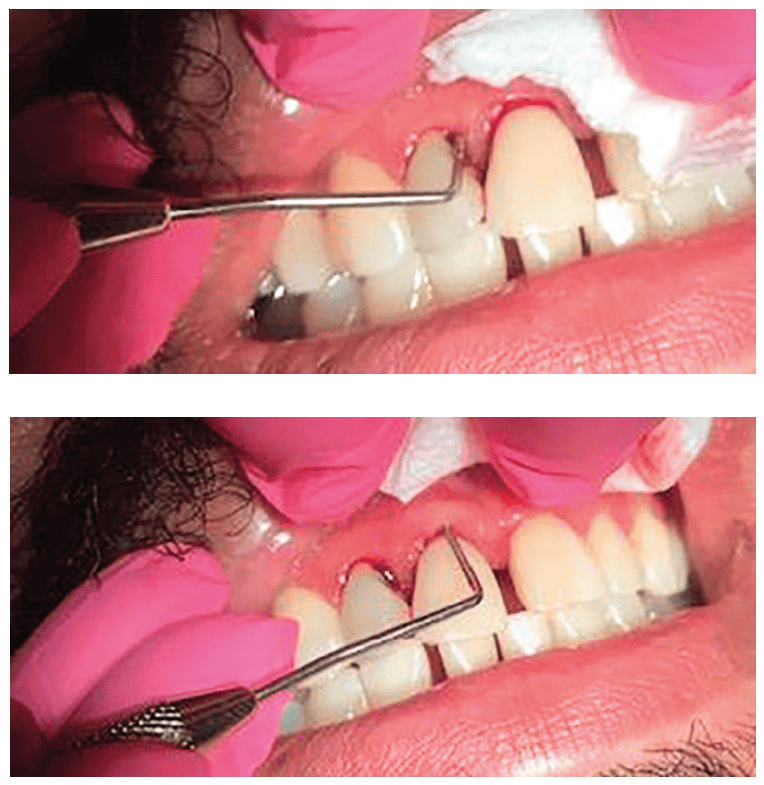 Pain management in dentistry to avoid opioid dependence