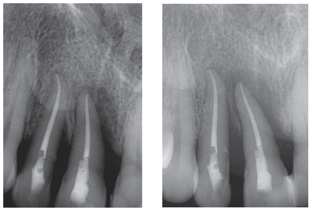 Pain management in dentistry to avoid opioid dependence