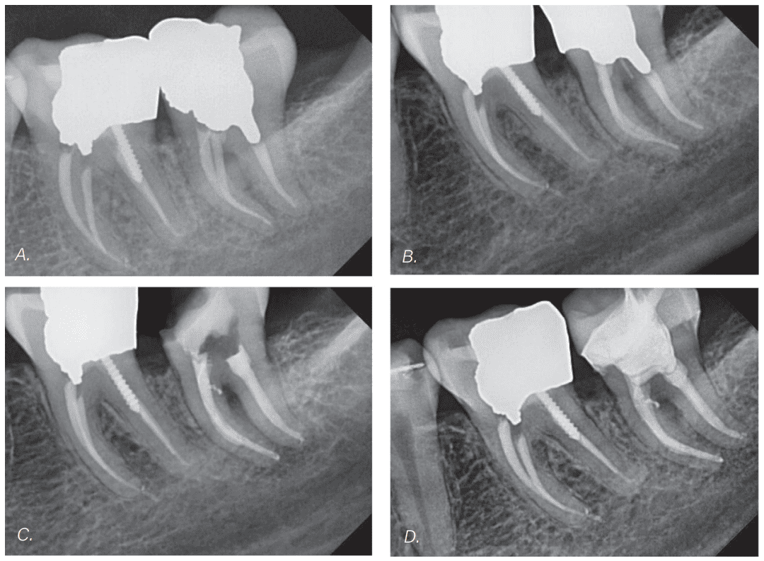 Lateral canals — cleaning and disinfection