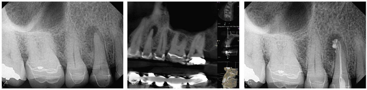 Lateral canals — cleaning and disinfection
