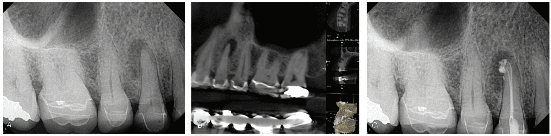 Lateral canals — cleaning and disinfection