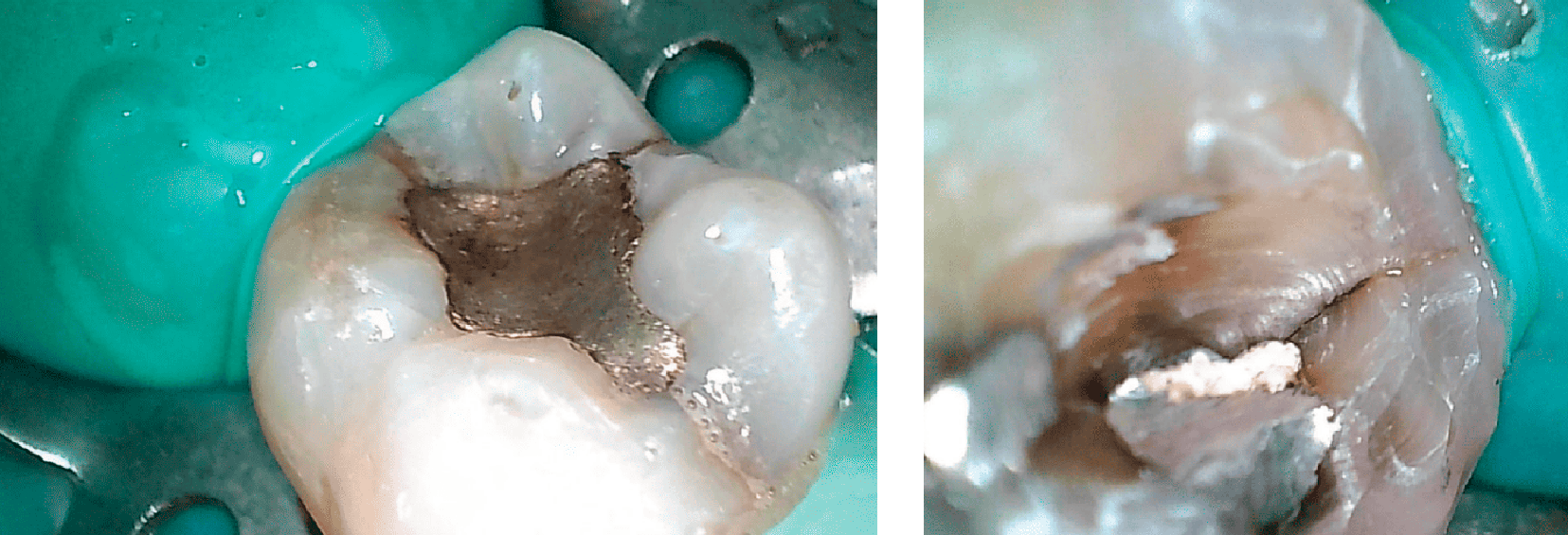 Cracked teeth — how to detect for the best prognosis