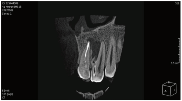 Dens invaginatus — exploring new treatment