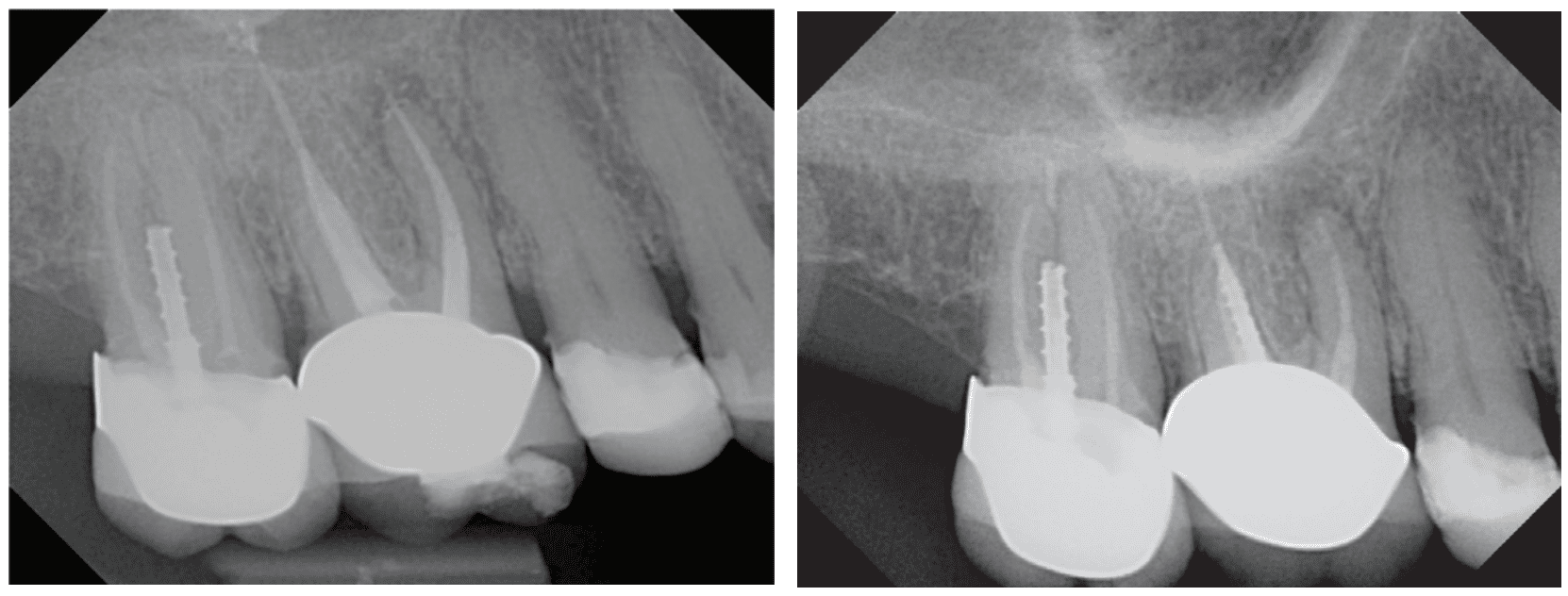 SS White — helping reach minimally invasive endodontic treatment