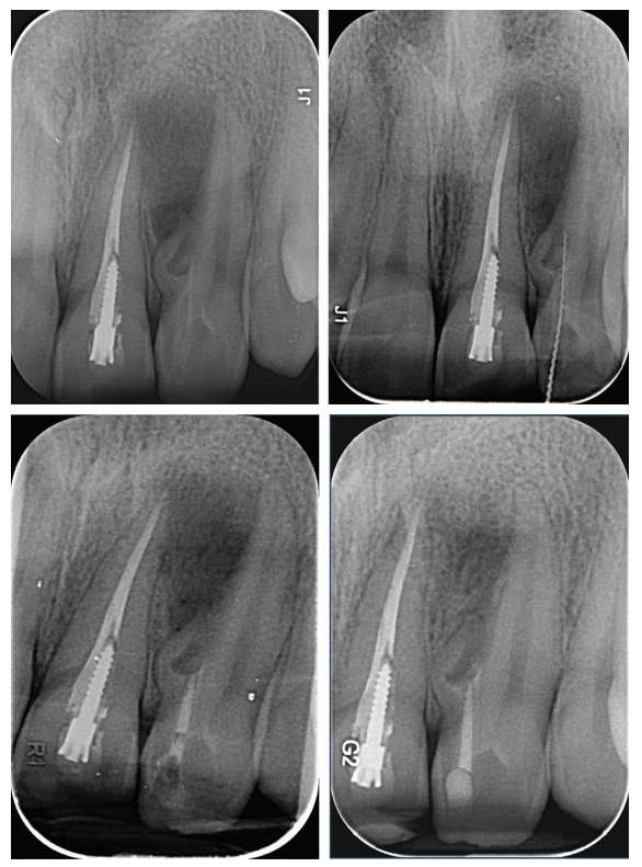 Dens invaginatus — exploring new treatment