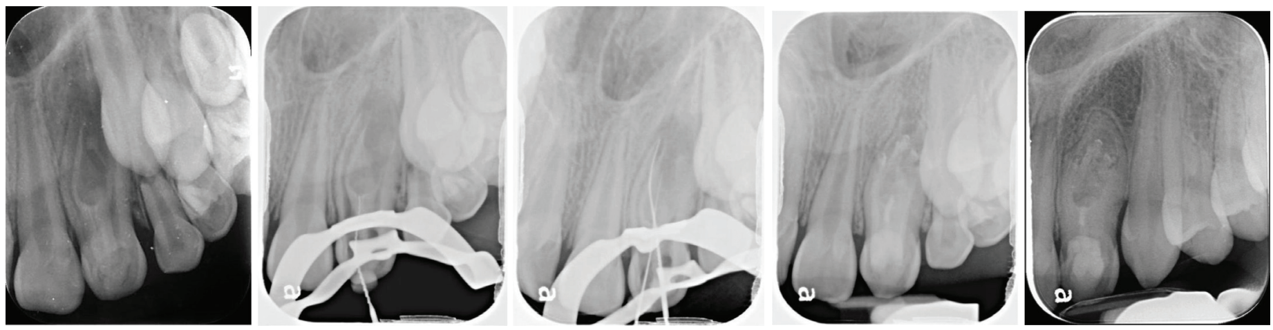 Dens invaginatus — exploring new treatment