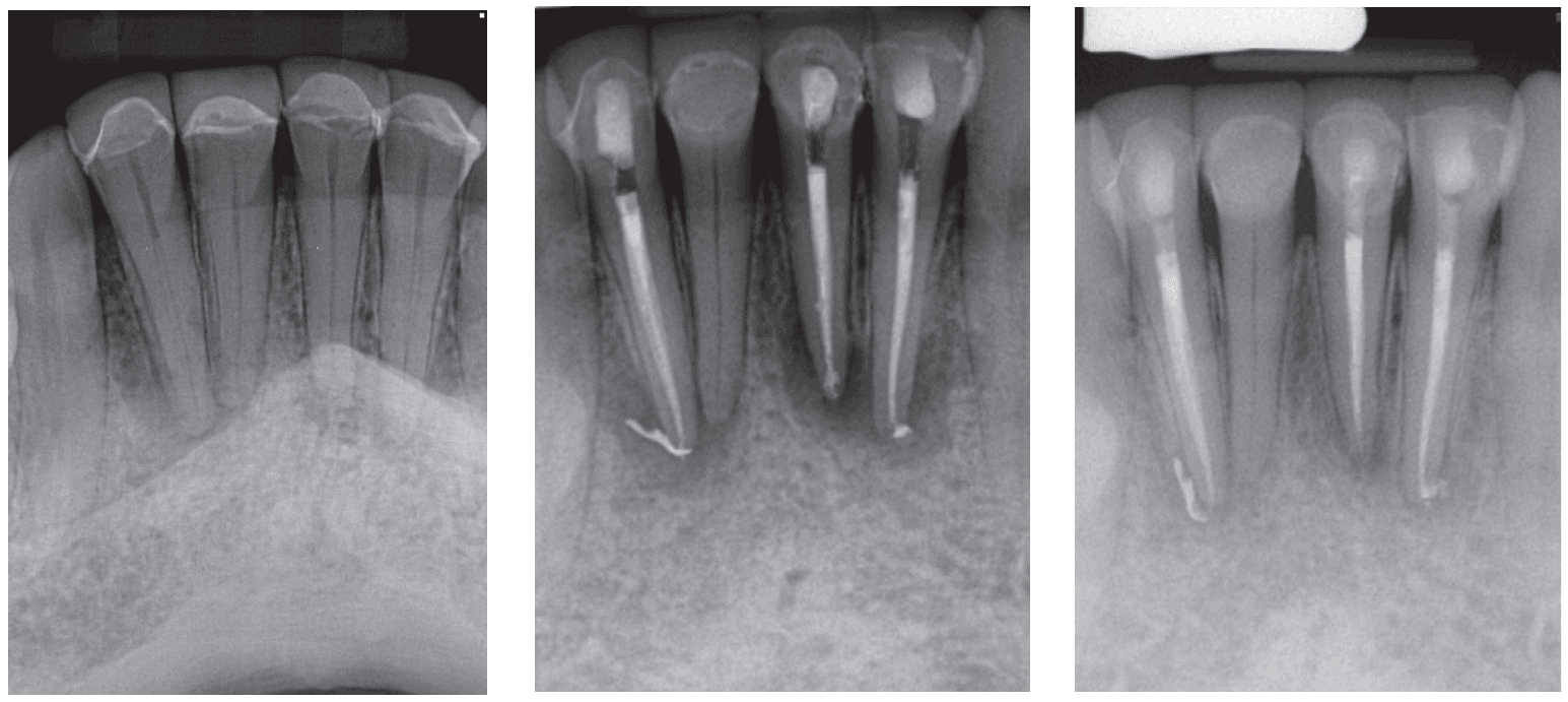 Endodontic anesthesia — improvements over the years