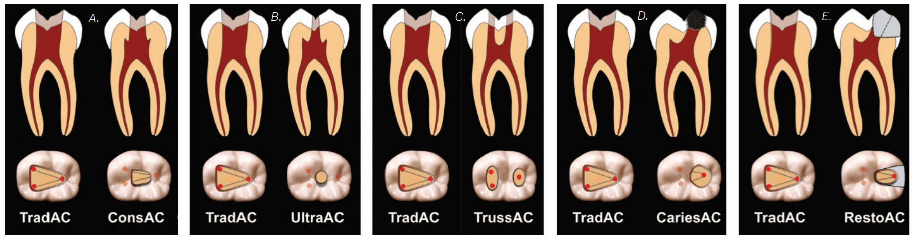 Access cavities — which one is more effective?
