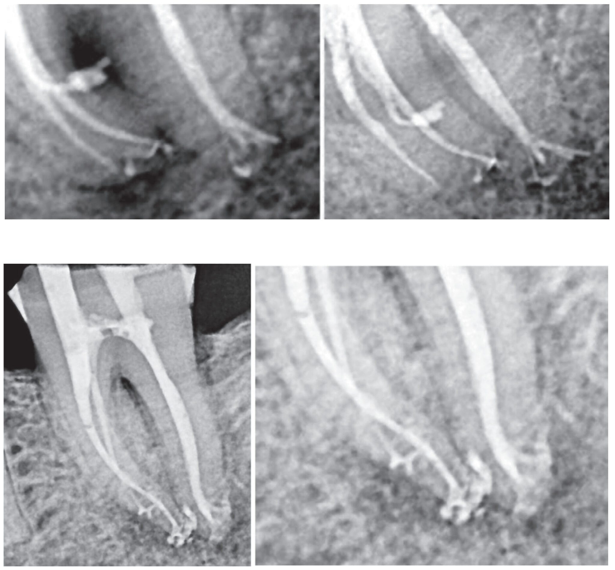 Enhanced endodontic irrigation methods — Pulp Sucker Irrigation System ...
