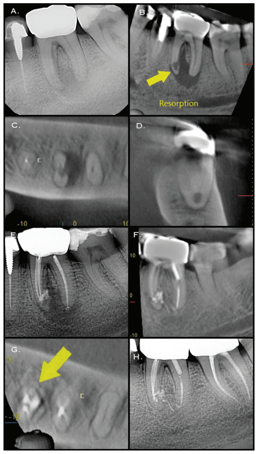 Perforating internal root resorption — an often symptomless problem